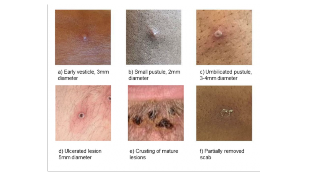 MPOX – Department of Public Health